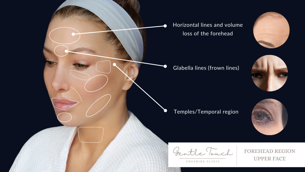 Horizontal Forehead Lines - Gentle Touch Clinic